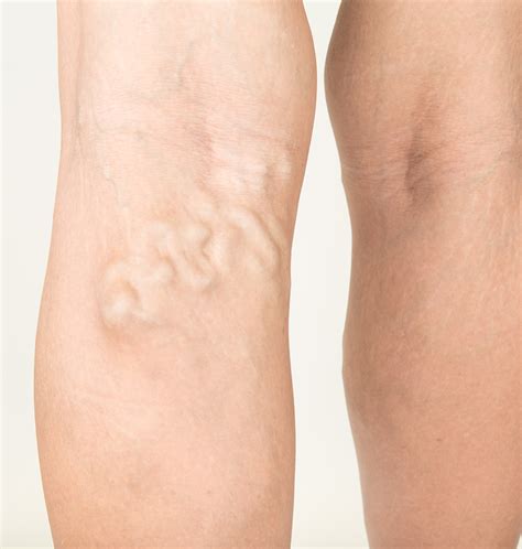 Vein Testimonial Vein Treatment Physicians Vein Clinics
