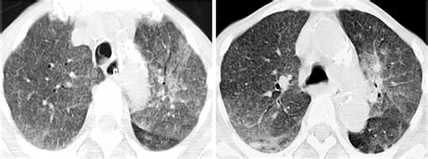 Chest Computed Tomography Showed A Pattern Of Diffuse Nodules In A