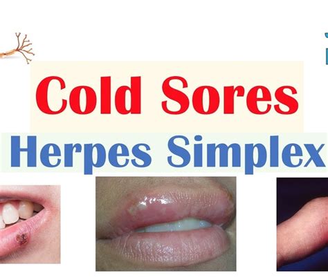 Cold Sores Oral Herpes Causes Signs And Symptoms Treatment