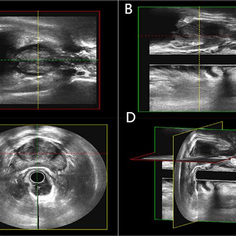 Three Dimensional Transrectal Ultrasonography 3d Trus A Coronal