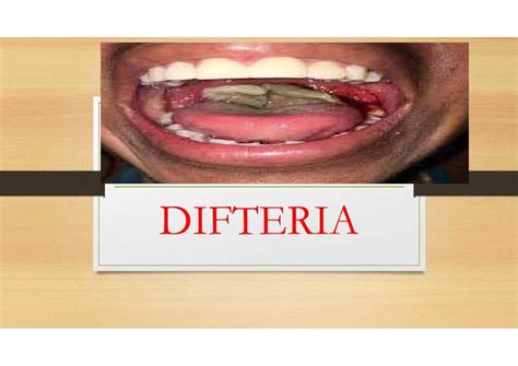 Difteria Medical Coffe Udocz
