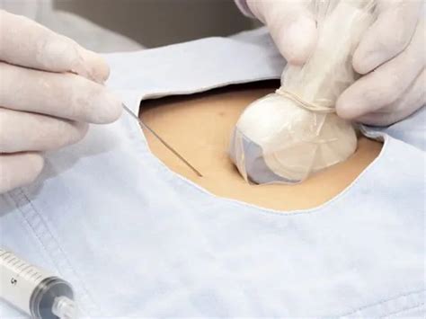 Ultrasound Guided Hip Injection Doctors Appointments