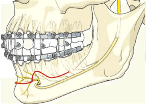 Diagramatic Representation Of The Incision Line Download Scientific Diagram