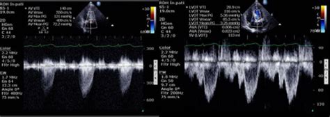 Echocardiogram Showing Doppler Measurements Download Scientific Diagram