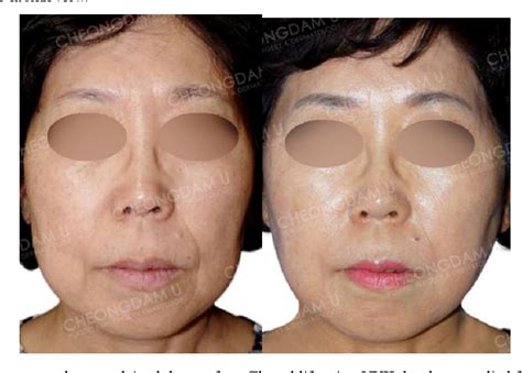 Figure 1 From The Renaissance Of Non Invasive Facial Rejuvenation A
