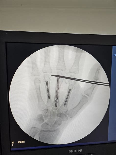Kishan Rao On Linkedin Multiple Metacarpal Fractures 29 Comments