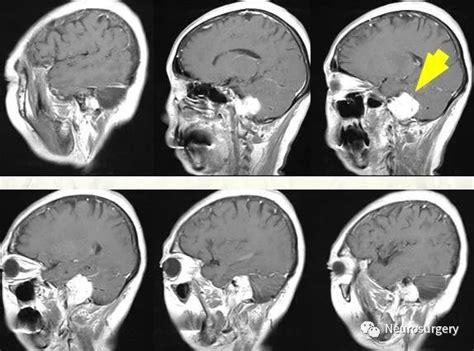 远外侧入路切除颈静脉孔区肿瘤 脑医汇