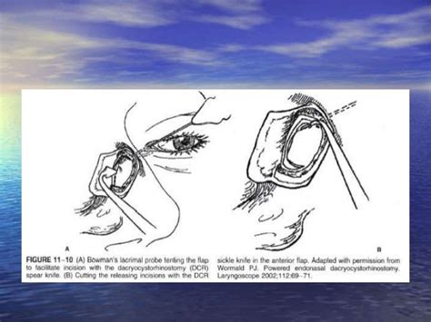 Endoscopic Dcr