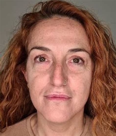 Resultados Blefaroplastia Antes Y Después Resultados