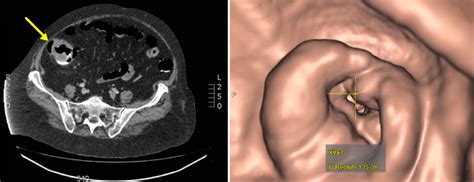 New Ct Colonography E Learning Sessions Sor