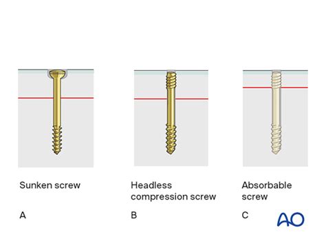 Orif Mini Fragment Or Headless Screws For Split Fractures Of The