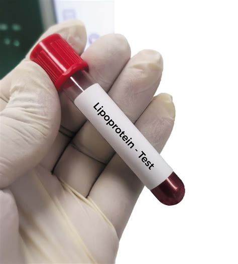 Lipoproteina An Update On Testing And Treatment Harvard Health
