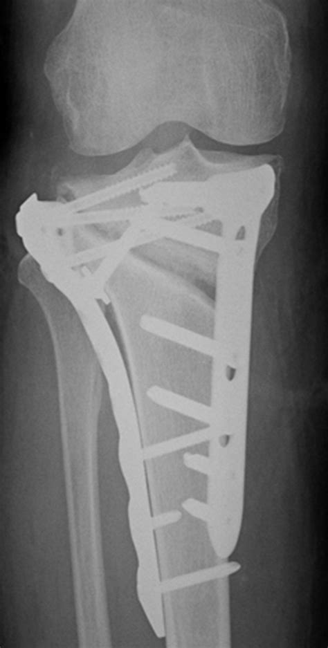 What Is A Hinge Fracture At Tracy Mcfall Blog