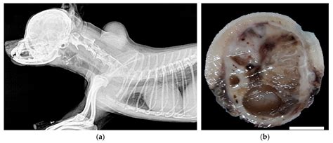 Immunophenotyping Of An Unusual Mixed Type Extraskeletal Osteosarcoma