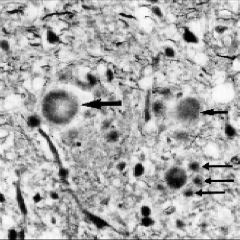 Several Prion Protein Prp Amyloid Plaques Of Different Sizes In The
