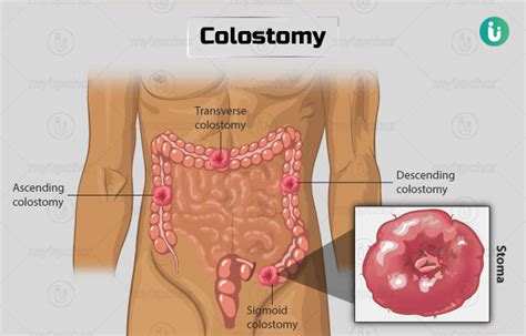 Colostomy Care Procedure