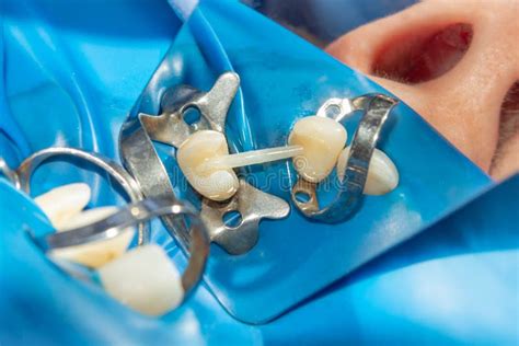 Restauratie Van Tanden Na Endodontic Behandeling Met Glasvezelspelden