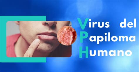 Virus Del Papiloma Humano Verrugas Sintomas Tratamiento Y 57 Off