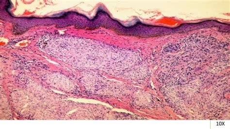 Cutaneous Sarcoidosis Sarcoidosis Approach To Cutaneous Sarcoidosis