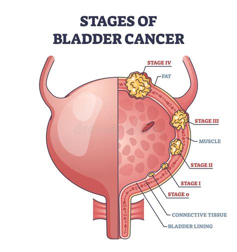 Stages Of Bladder Cancer With Anatomical Oncology Model Outline Diagram