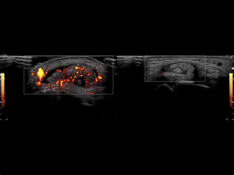 Extensor Compartment 4 Tenosynovitis Ultrasound Cases