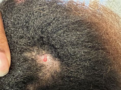 Syringocystadenoma Papilliferum Rdermatologyquestions