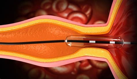 Angioplasty What Is Types Who Needs It And Recovery Time