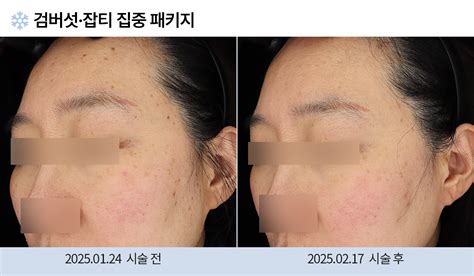 노원피부과진료 스노우의원 노원점 노원보톡스 노원여드름