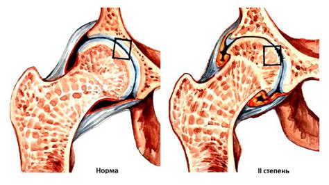 Коксартроз тазобедренного сустава 2 степени причины и лечение