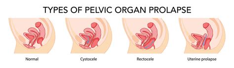 Nw Integrative Medicine Pelvic Floor Dysfunction And Treatment In