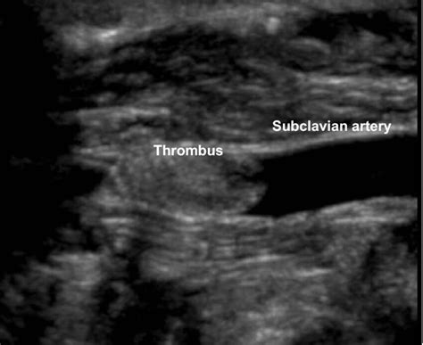 Ultrasound Image Of Occlusive Thrombus In The Subclavian Artery