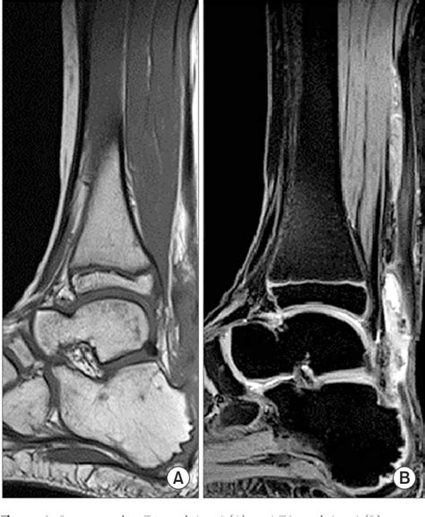 Figure 1 From Calcaneal Apophyseal Avulsion Fractures With Achilles