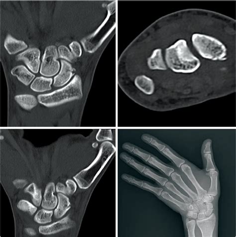 A Comminuted Fracture In Computed Tomography Scans And Radiographs Download Scientific Diagram