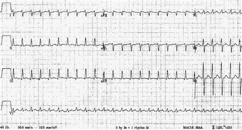 Ecg Case 093 • Litfl • Ecg Top 100 Self Assessment Quiz