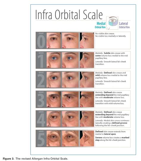 Creation And Validation Of A Photonumeric Scale To Assess Volume Deficiency