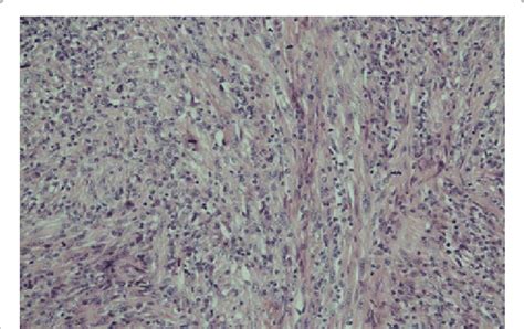 Histopathological Image Of The Tumour Showing Spindle Cells Arranged