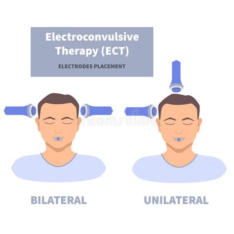 Ect Electroconvulsive Therapy For Severe Depression Treatment Stock