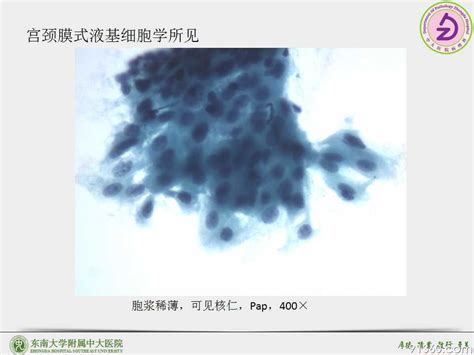巨大平滑肌肉瘤伴广泛坏死讨论病例【东南大学附属中大医院】 东南大学附属中大医院病例分享 91360病理论坛