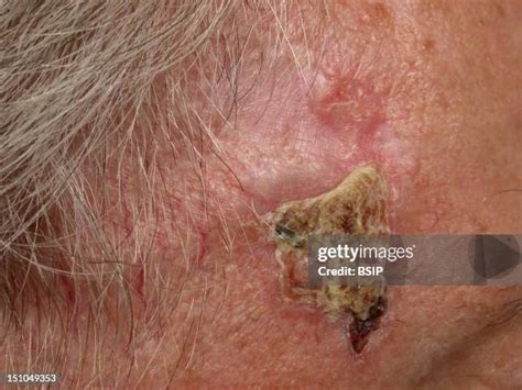 Basal Cell Carcinoma Photos And Premium High Res Pictures Getty Images