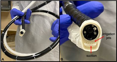 An Intraprocedural Cleansing System To Improve Inadequate Bowel
