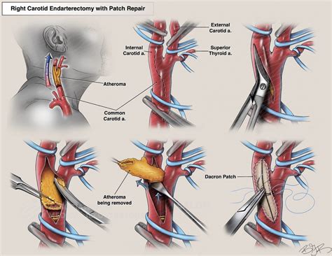 Right Carotid Endarterectomy With Patch Repair Ami Meeting 2021