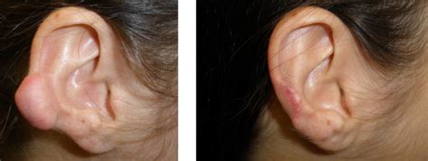 Ear Keloids Removal Surgery Before And After Pics Healthteria