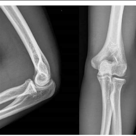 A Preoperative Radiograph Showing A Loose Body In The Olecranon Fossa Download Scientific