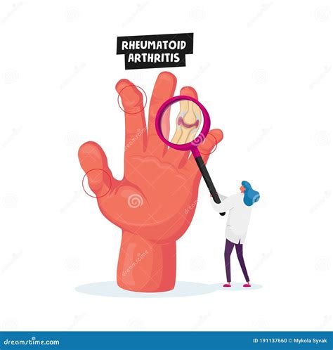 Artritis Reumatoide Pequeño Personaje Médico Mirando En Mano Enorme