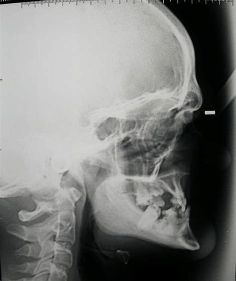 Cephalometry Film Showing A Third Skeletal Class Download Scientific