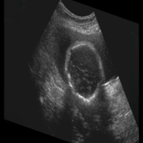 Fetal Brain Abnormality Classification Object Detection Dataset V2