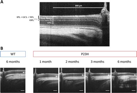 Sd Oct Retinal Thickness Layers And Retinal Morphology A Outer Download Scientific Diagram