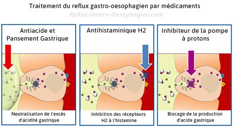 Traitement du reflux gastrique par médicaments reflux gastro