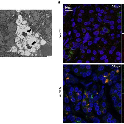 Pancreatic Neuroendocrine Neoplasms Pannens Demonstrate High Levels