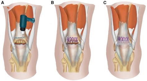 Icd 9 Quadriceps Tendon Repair